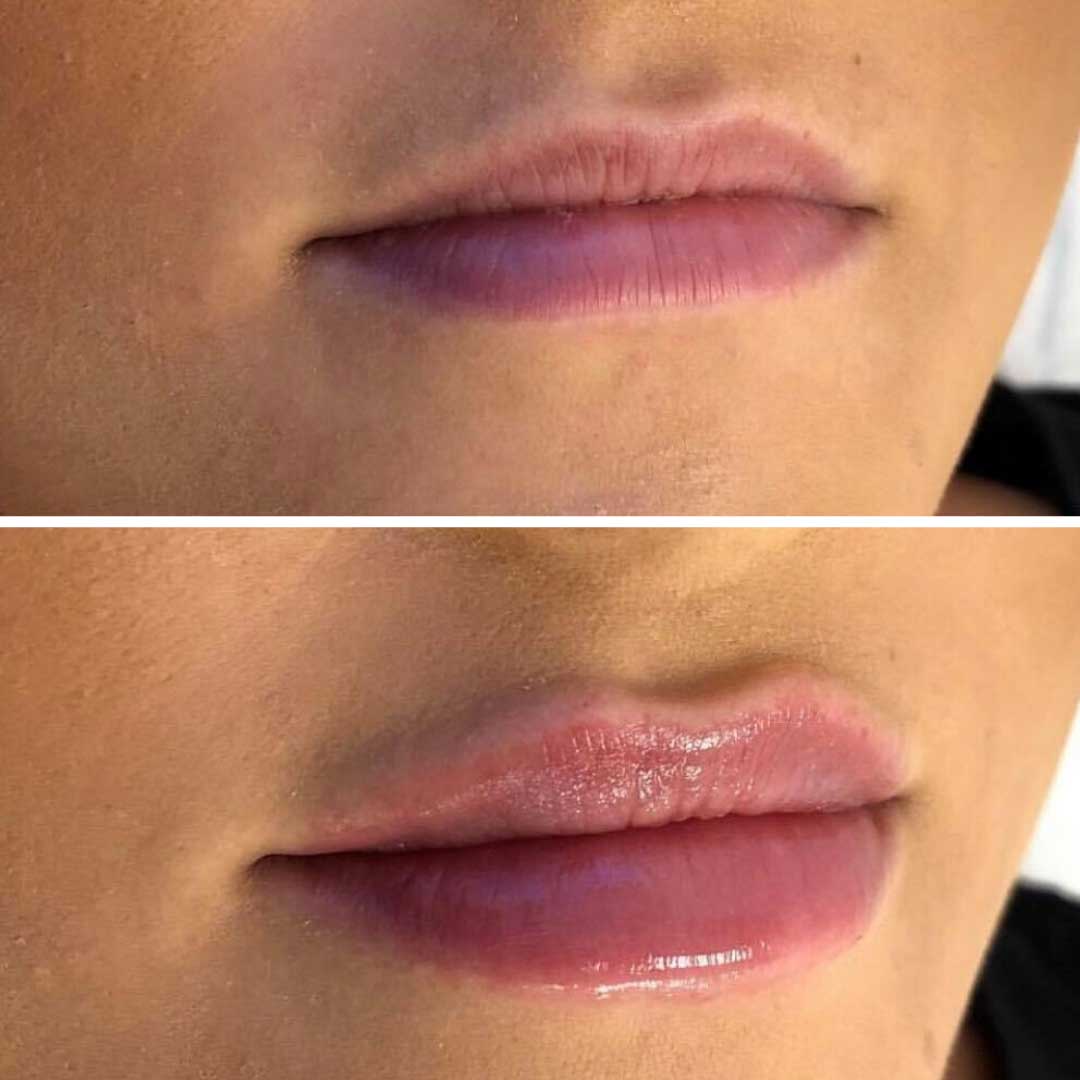 SKINVIVE | The first and only injectable for hydration now at Catalyst