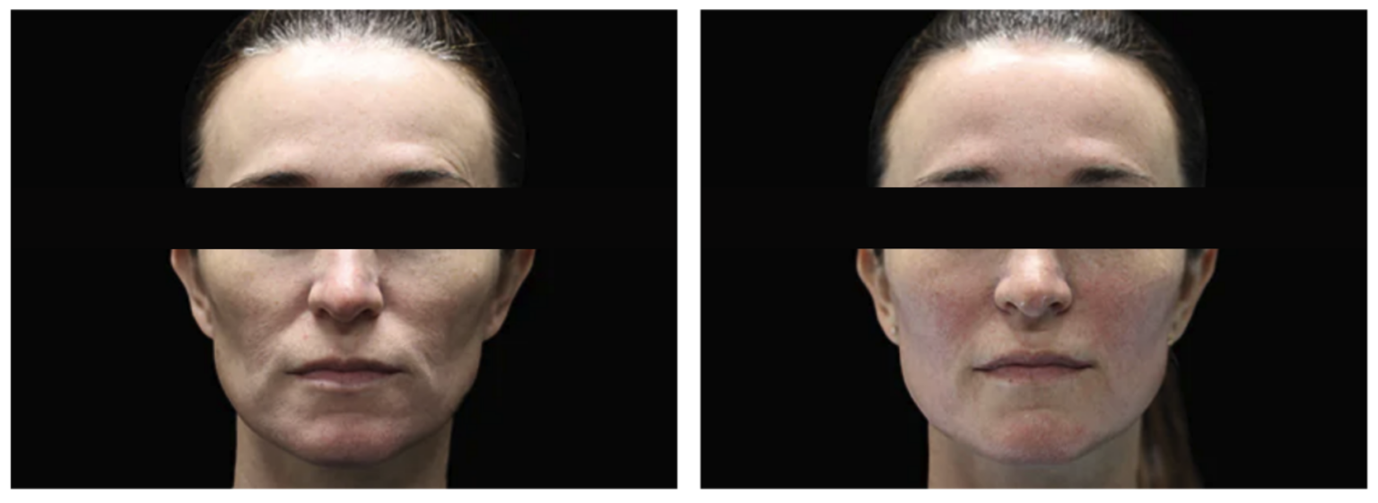 EMFACE® in Fargo–Revolutionary Facial Sculpting Treatment at Catalyst