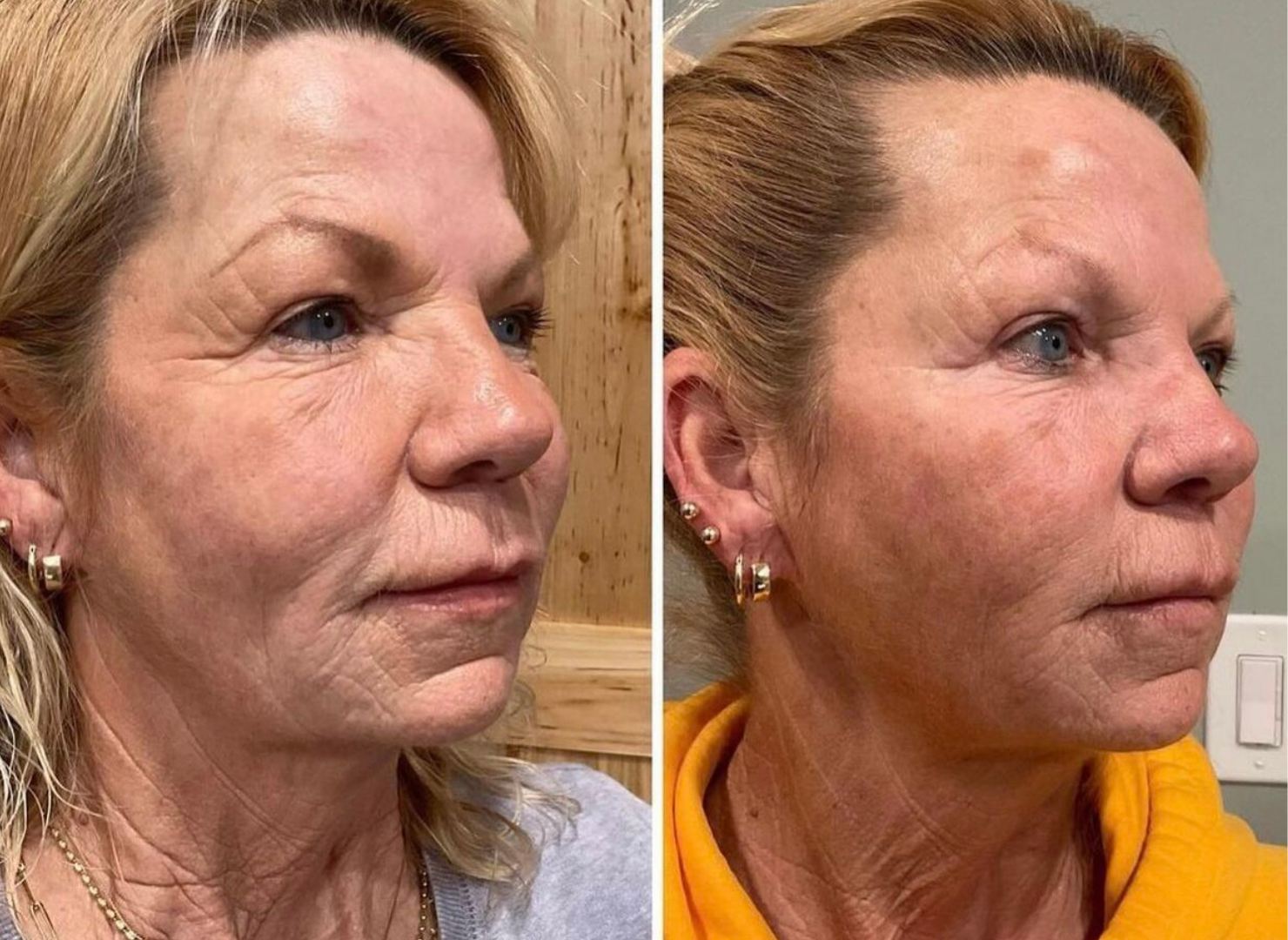 EMFACE® in Fargo–Revolutionary Facial Sculpting Treatment at Catalyst