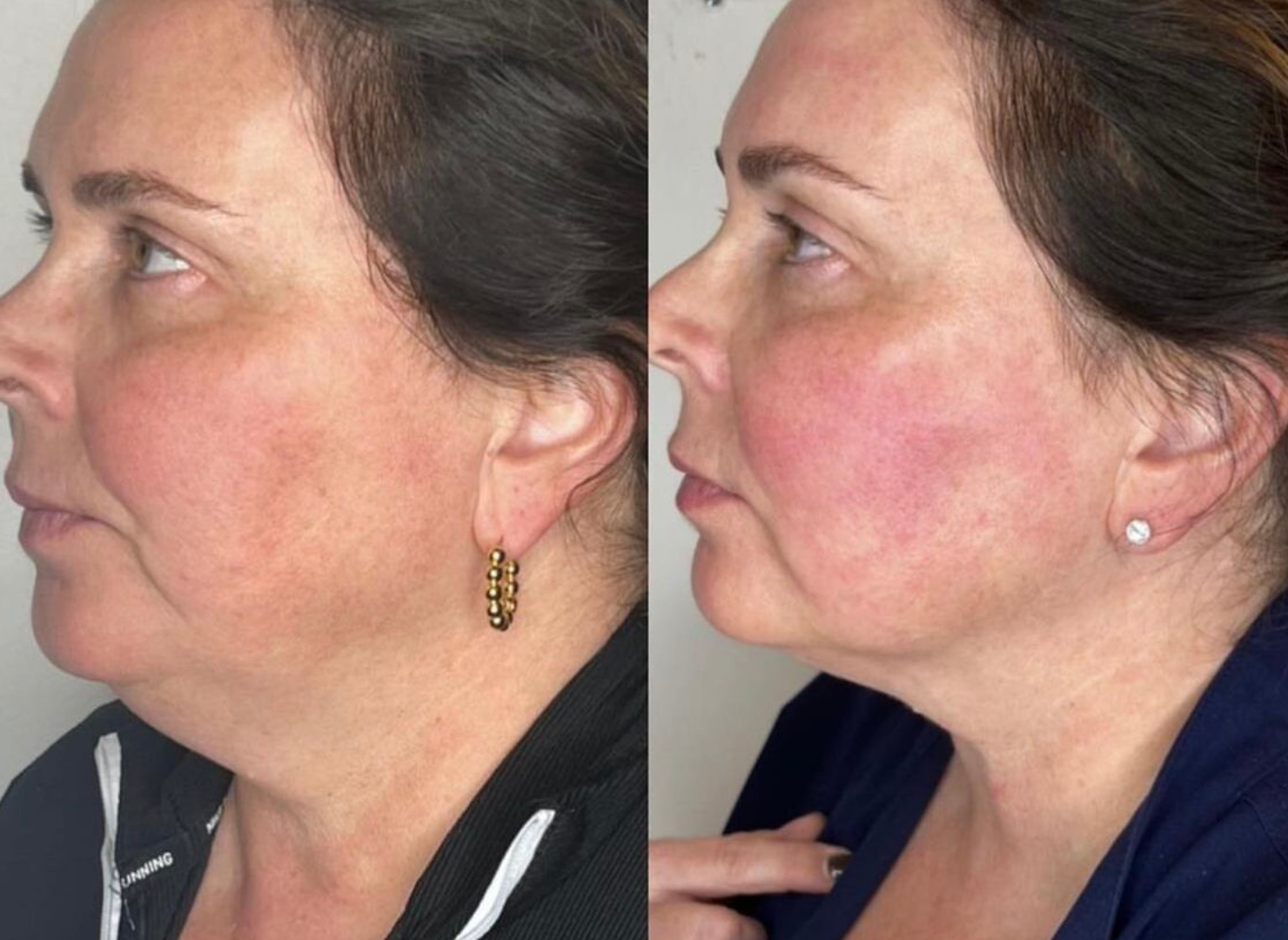 EMFACE® in Fargo–Revolutionary Facial Sculpting Treatment at Catalyst