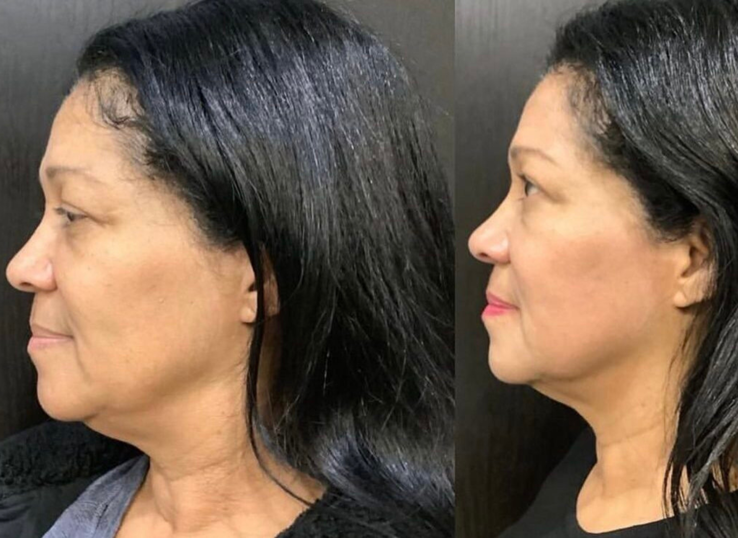 EMFACE® in Fargo–Revolutionary Facial Sculpting Treatment at Catalyst