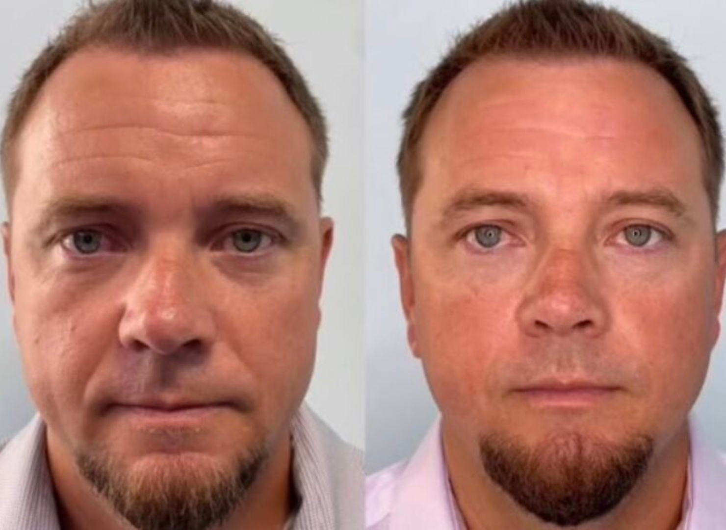 EMFACE® in Fargo–Revolutionary Facial Sculpting Treatment at Catalyst